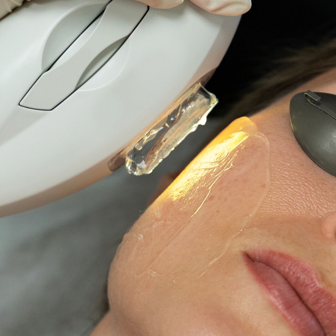 IPL Fraccionado: Tratamiento Vascular – Doctora Mardones